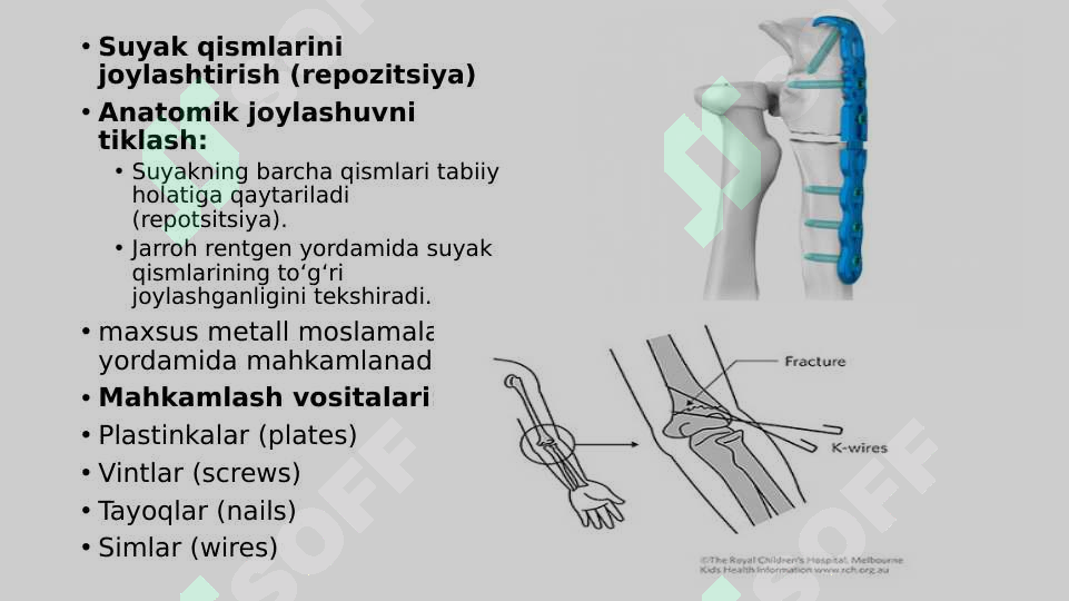 SUYAK SINISHIDA BAJARILADIGAN TASHQI VA ICHKI OSTEOSINTEZ JARROHLIK USULI