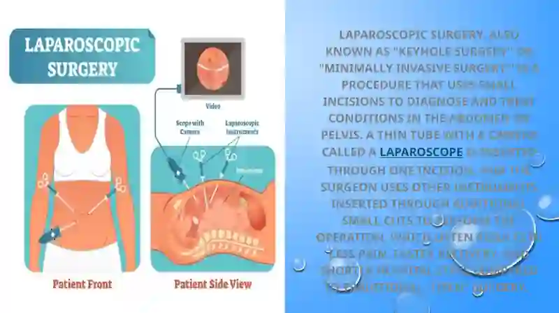 Laparoscopic Surgery. Laparoscopic Splenectomy. Surgery of the Pancreas ...