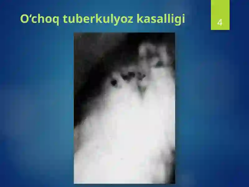 Tuberkulyoz Kasalligi